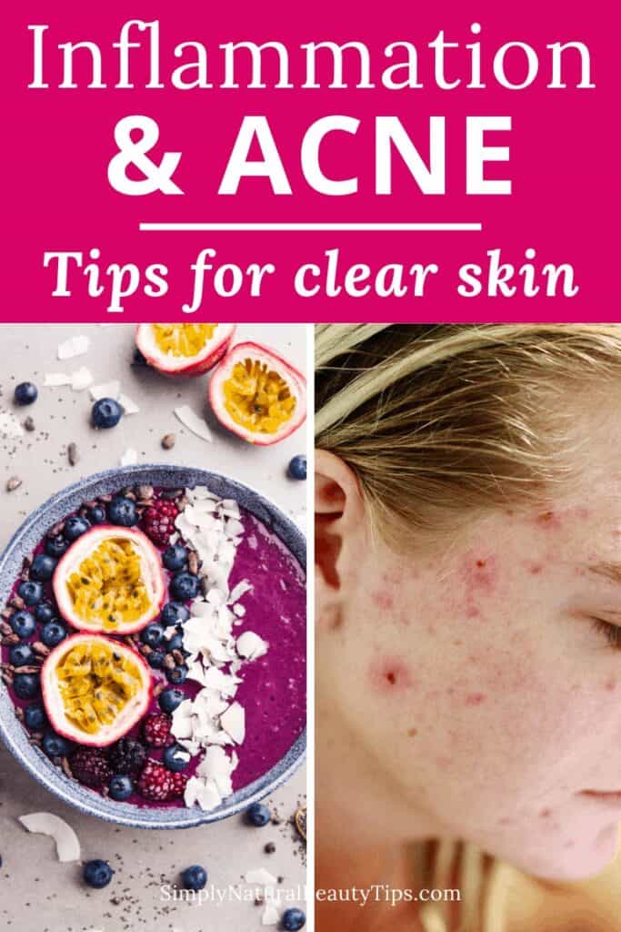 Does Inflammation In the Body Cause Acne? - Simply Natural Beauty Tips